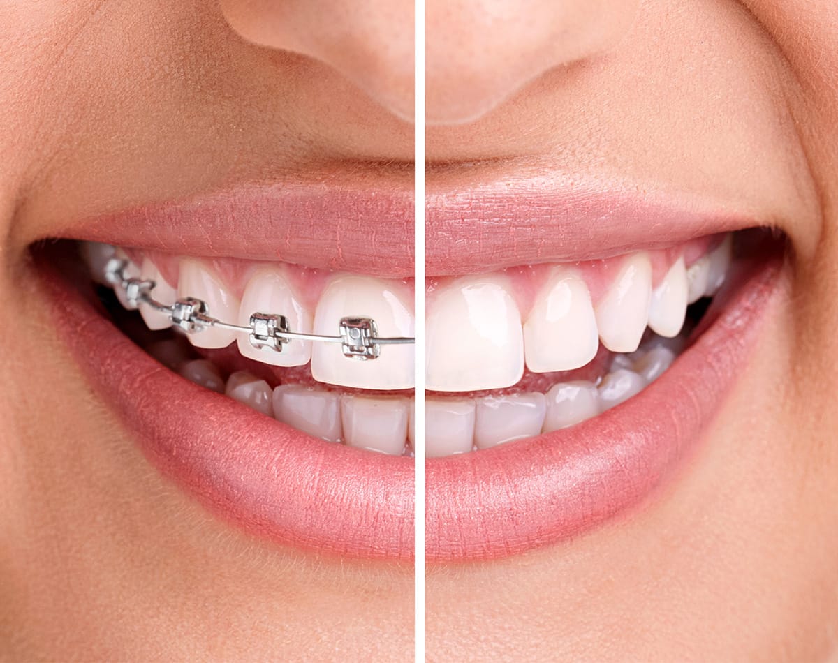 Metallic Braces in Dubai – Effective & Affordable Solution