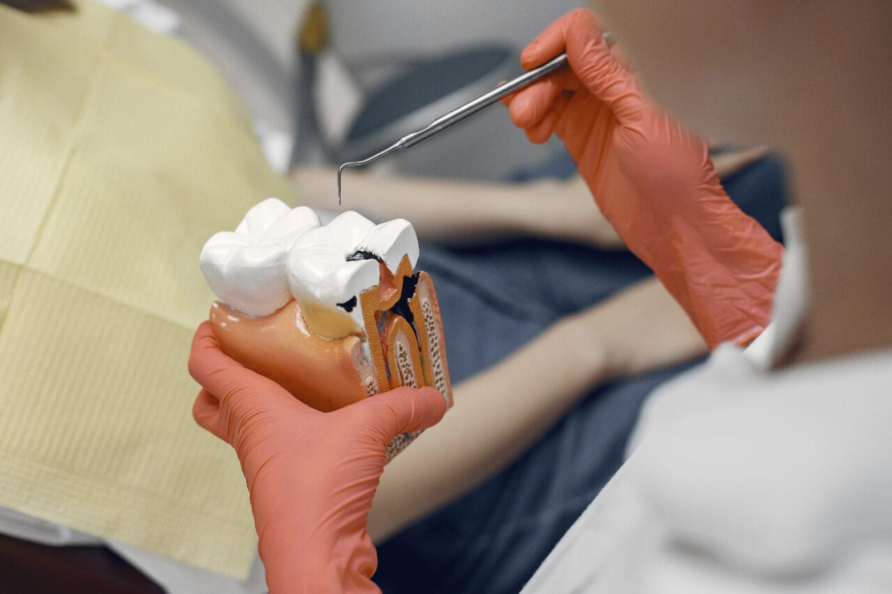 Cavities Uncovered: What Causes Them and How to Prevent Them ...